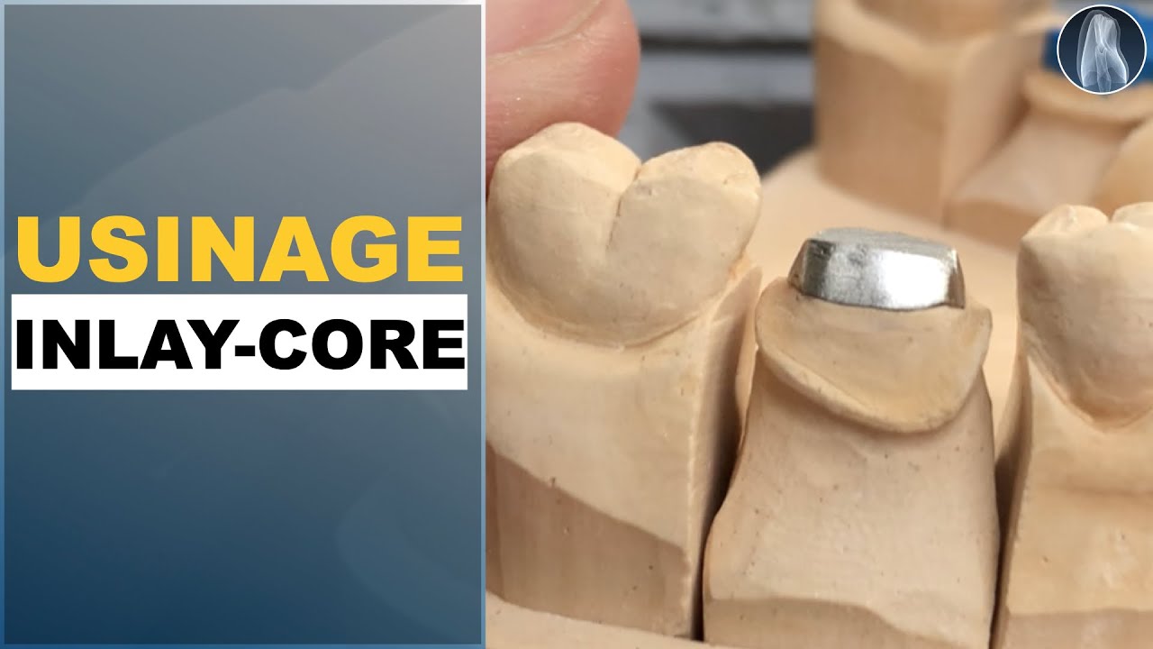 Usinage d’un Inlay-Core : Guide Complet avec ou sans Clavette 🦷 - YouTube