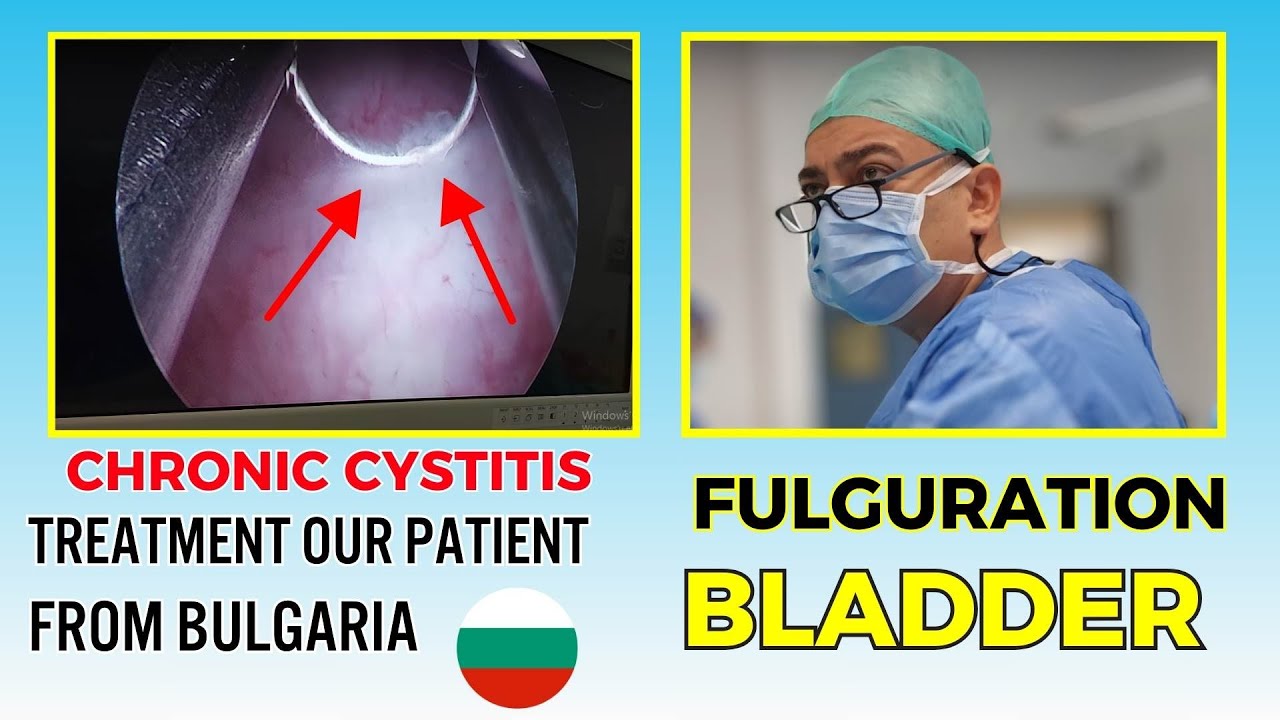 Bladder Fulguration of Chronic Cystitis Treatment Our Patient from ...