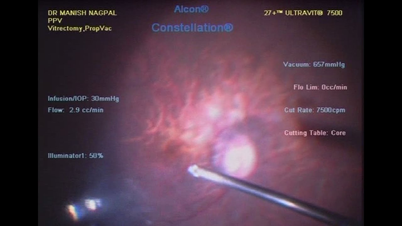 Vitrectomy for Floaters | Myopia | Vitreous degeneration | 27 gauge ...