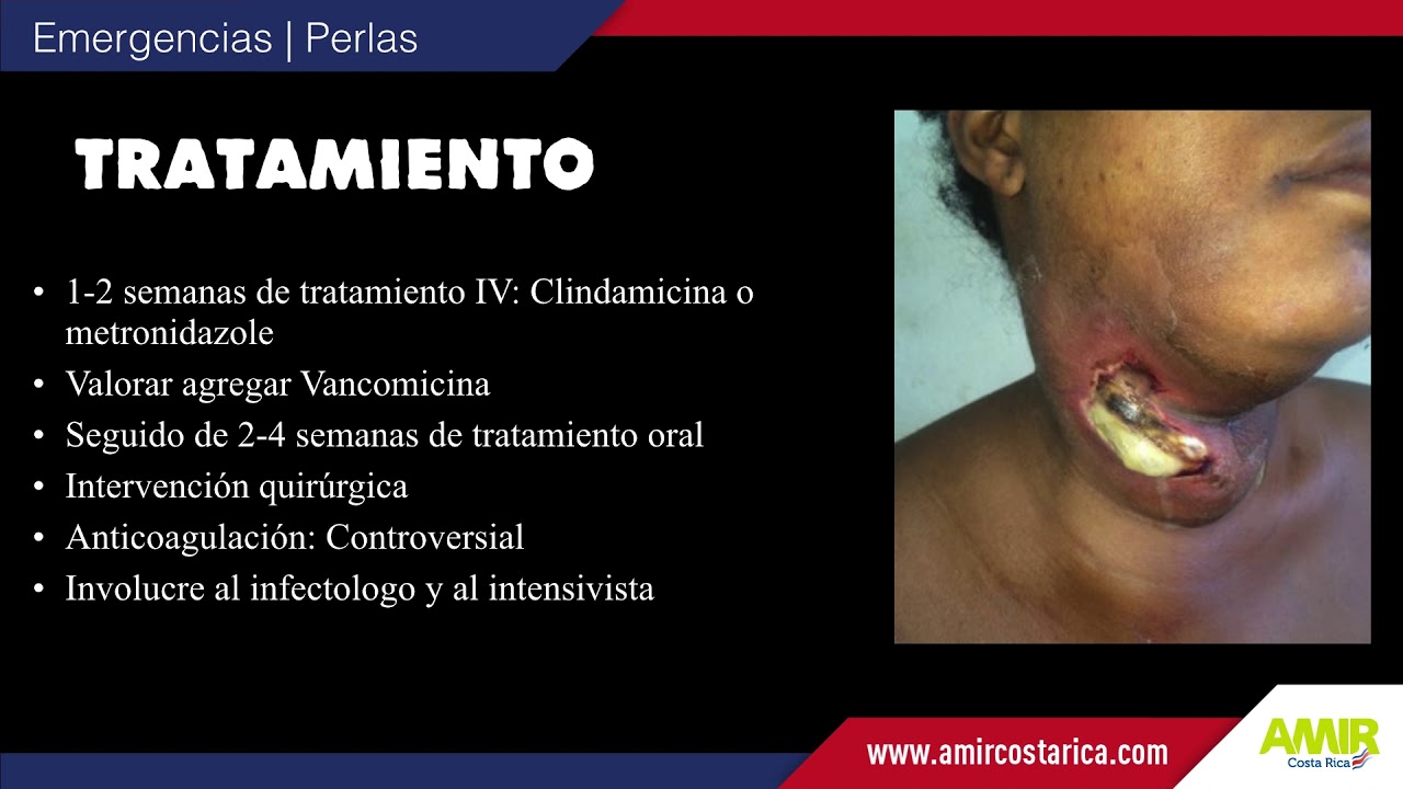 Síndrome de Lemierre: la enfermedad olvidada. - YouTube