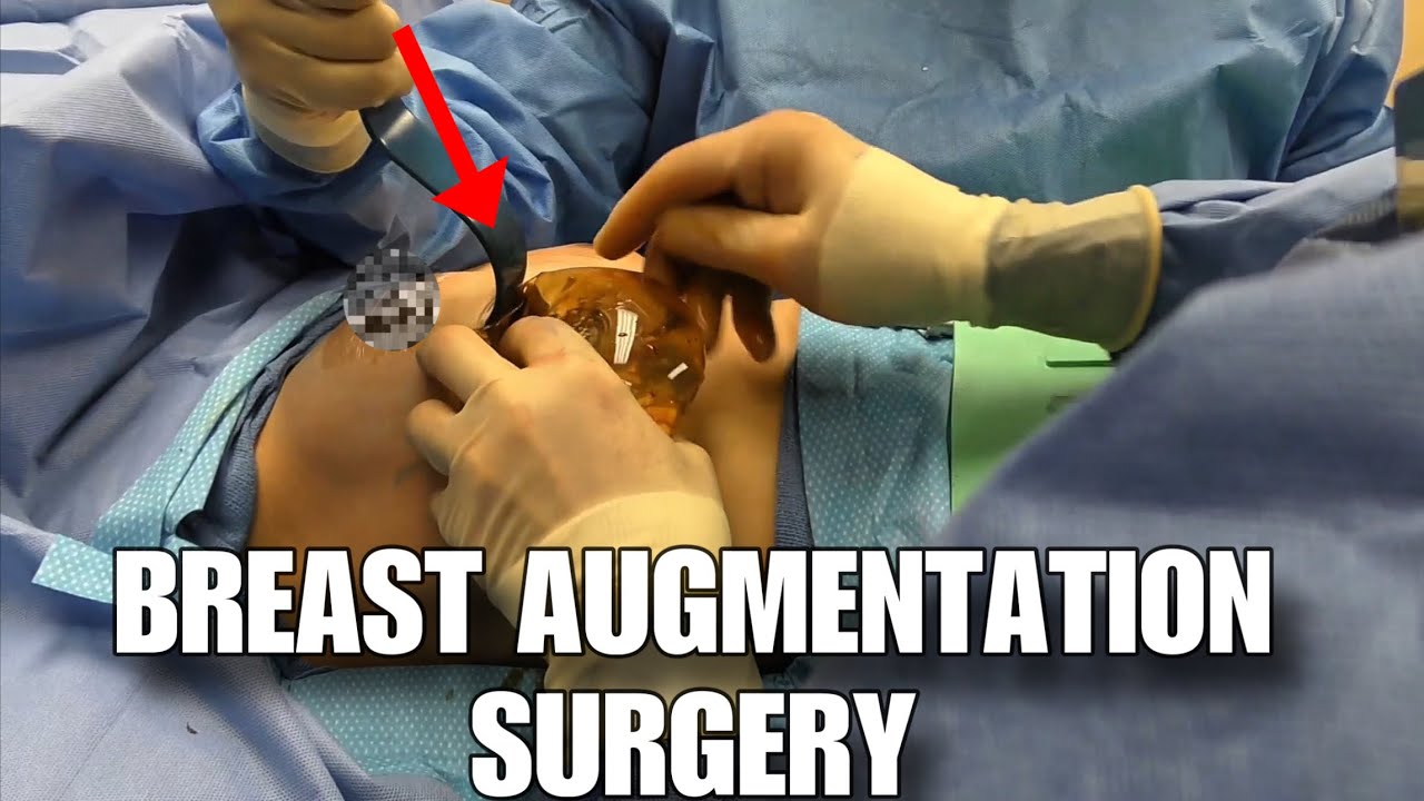 Breast Augmentation Surgery Performed by Dr. Mark Jabor - YouTube