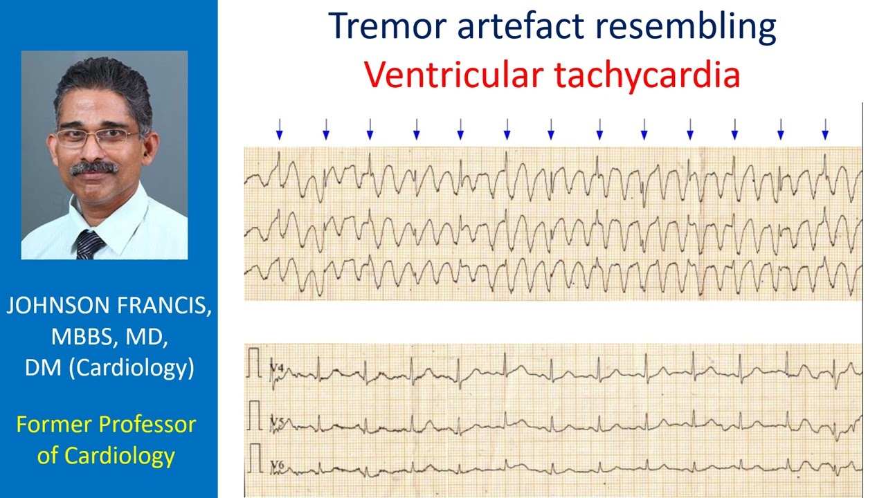 Tremor artefact resembling ventricular tachycardia - YouTube