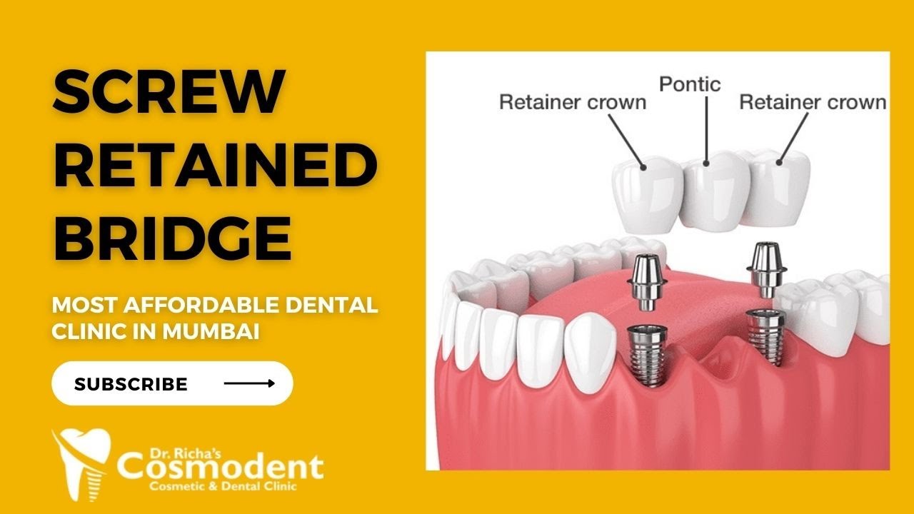 Screw Retained Bridge | Most Affordable Dental Clinic in Mumbai ...