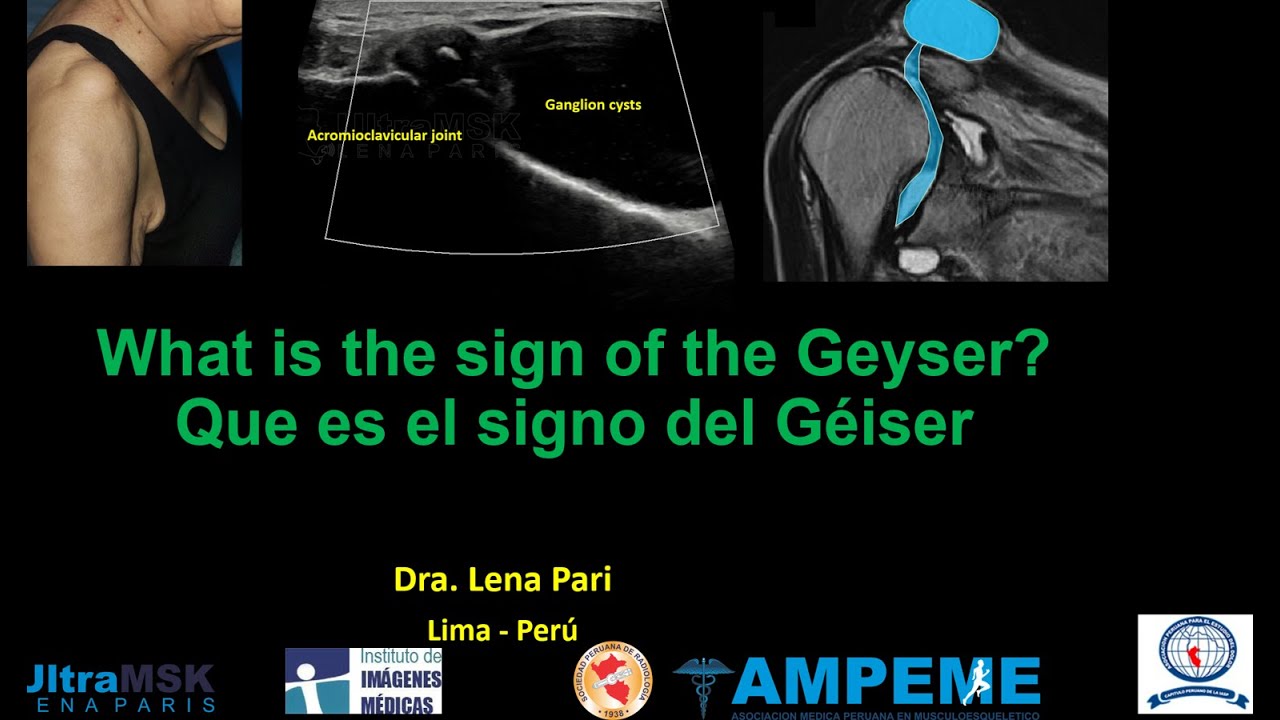 ¿Qué es el signo del Géiser? / What is the sign of the geyser? Dra ...