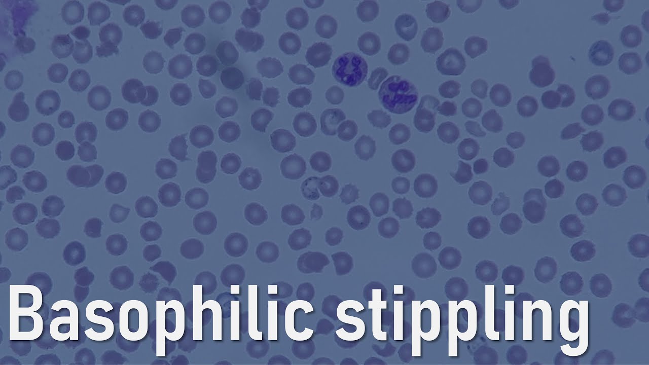 Basophilic Stippling Basophilic Stippling Of Erythrocytes In