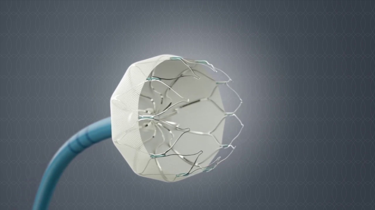 The Watchman Implant - Peter Friedman, MD - YouTube