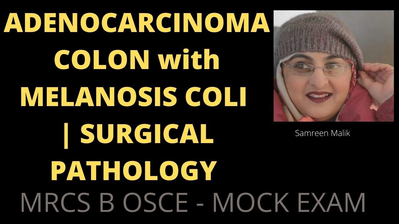 ADENOCARCINOMA COLON with MELANOSIS COLI | SURGICAL PATHOLOGY - YouTube