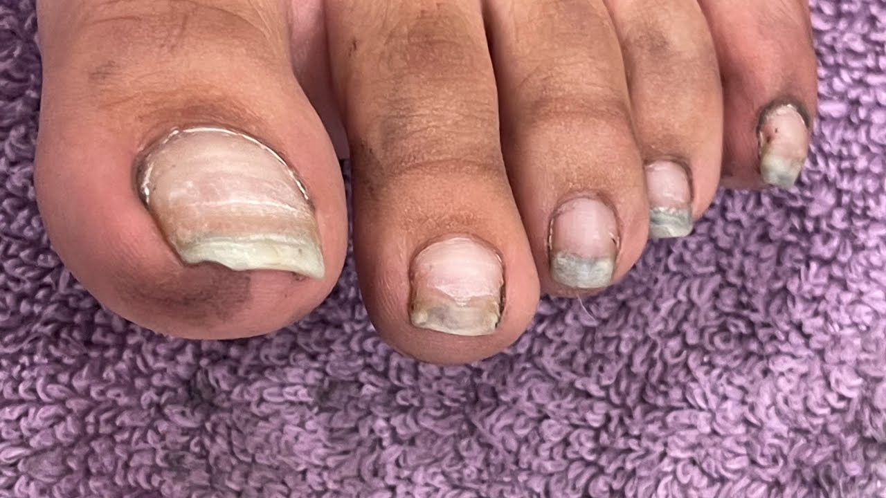 How to remove ingrown,cuticles, dirt and cut long nails. - YouTube