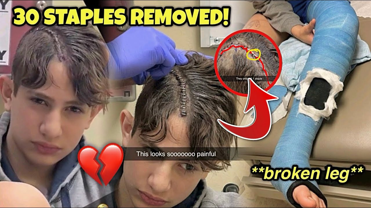 Nidal Wonder’s Head STAPLES Removed?! 😦 **Back in the Hospital** - YouTube