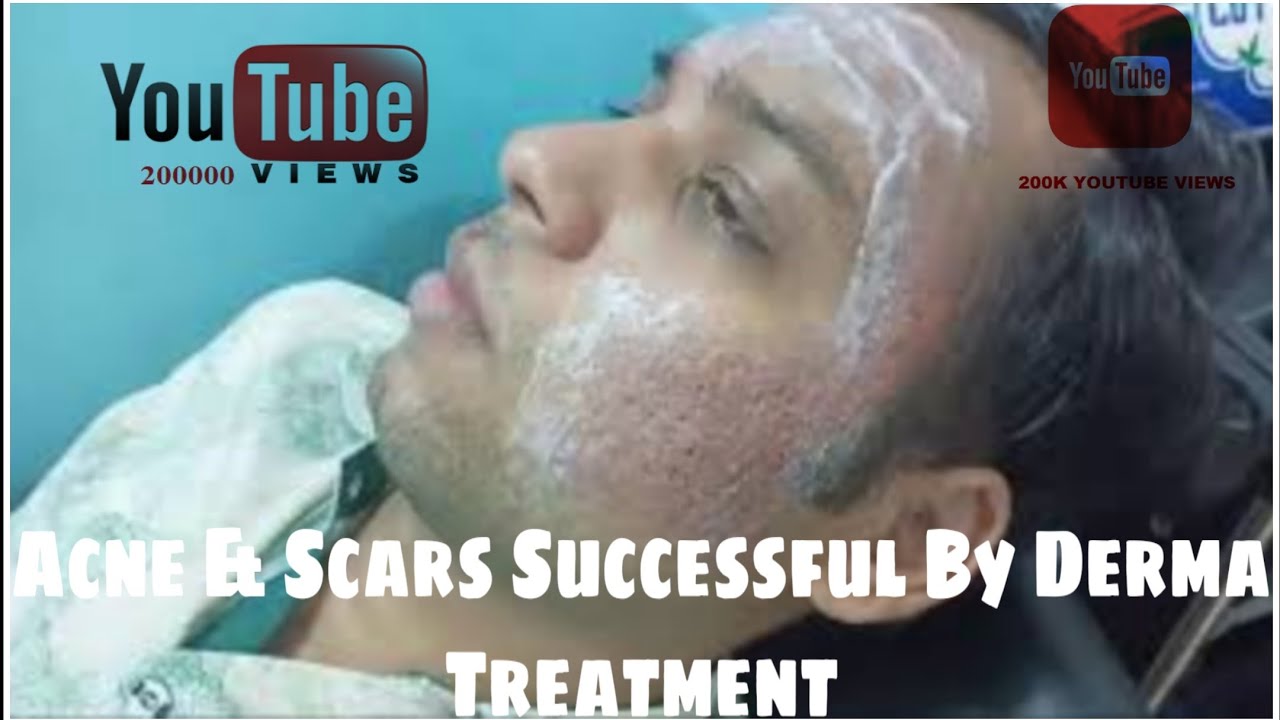 Derma Roller For Acne & Scars Treatment Part 1 - YouTube