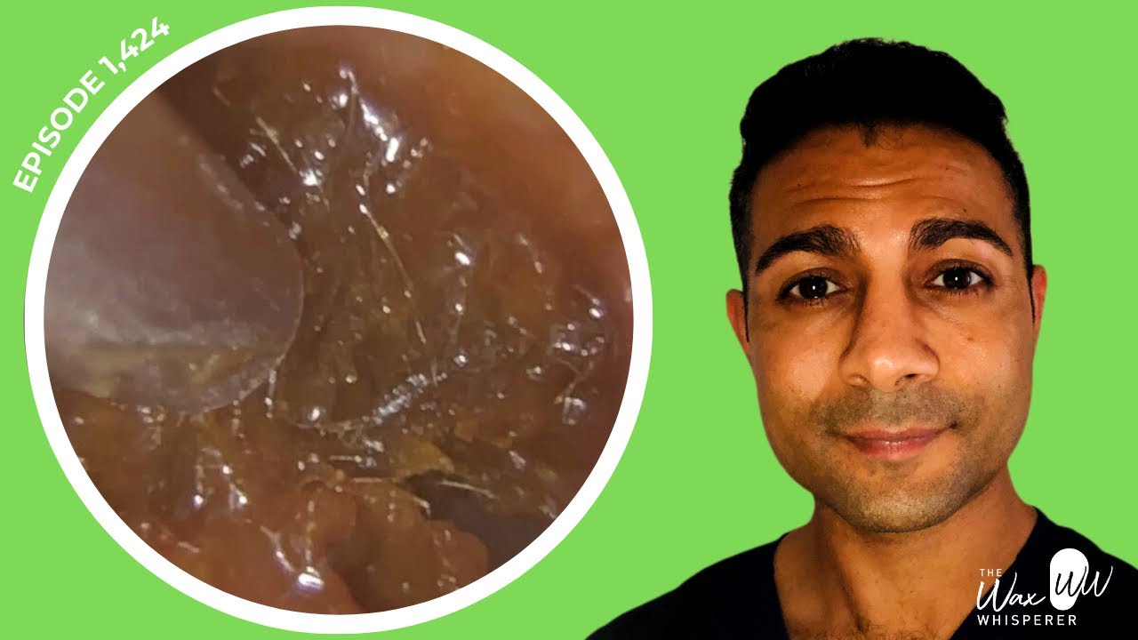 1,424 - Patient Becomes Emotional & Breaks Down in Tears During Ear Wax ...