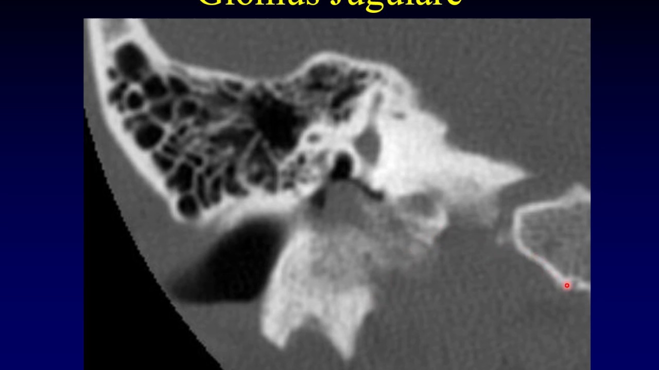 Temporal Bone Pathology 4: Jugular Bulb - YouTube