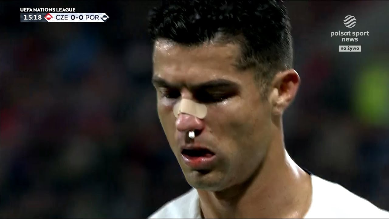 Cristiano Ronaldo Bloody Injury vs Czech - YouTube
