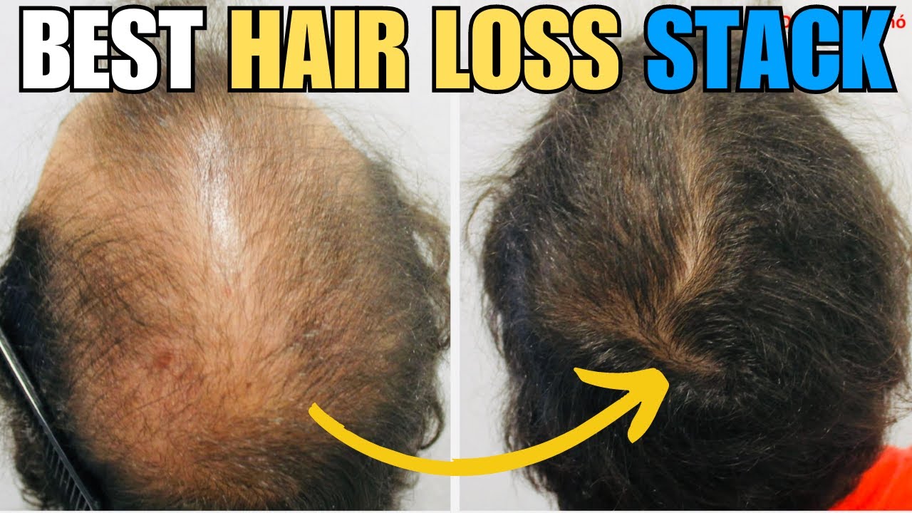 The Best Hair Loss Stack Dr Sergio Vaño Europes Top Hair Loss Doctor