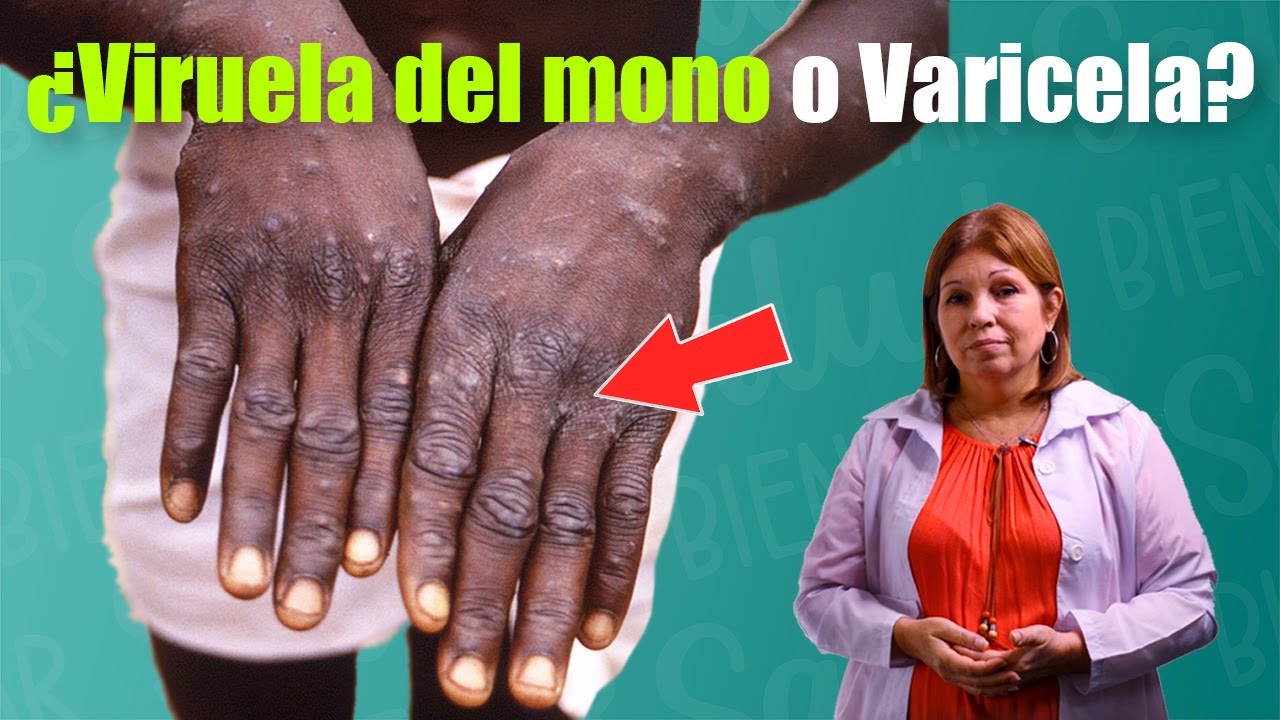 🔸CÓMO DIFERENCIAR LA VARICELA Y LA VIRUELA DEL MONO? 🐵 - YouTube