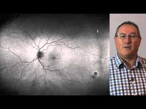 Peripheral Retinal Degenerations (2013) - Simon Browning B.Sc. (Hons) MCOptom