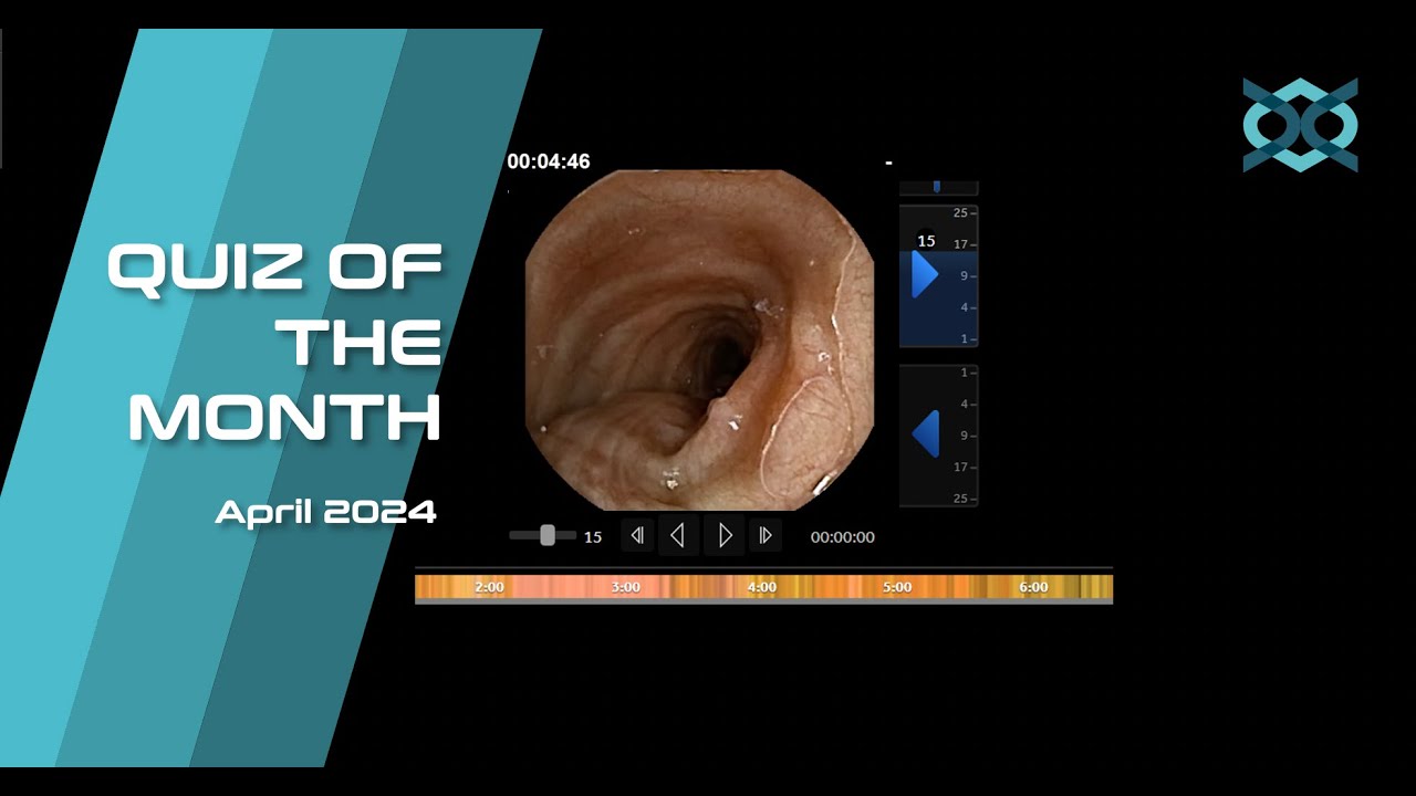 Mucosal trachealization detection by Capsule Endoscopy - YouTube