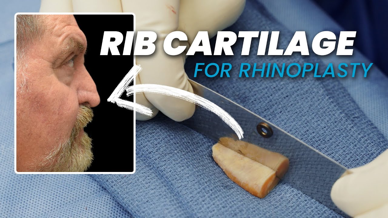 Rib Allograft in Rhinoplasty: How the Technique Enhances Your Nose ...