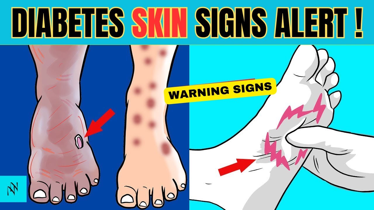 10 Alarming Skin Signs Of Diabetes - YouTube