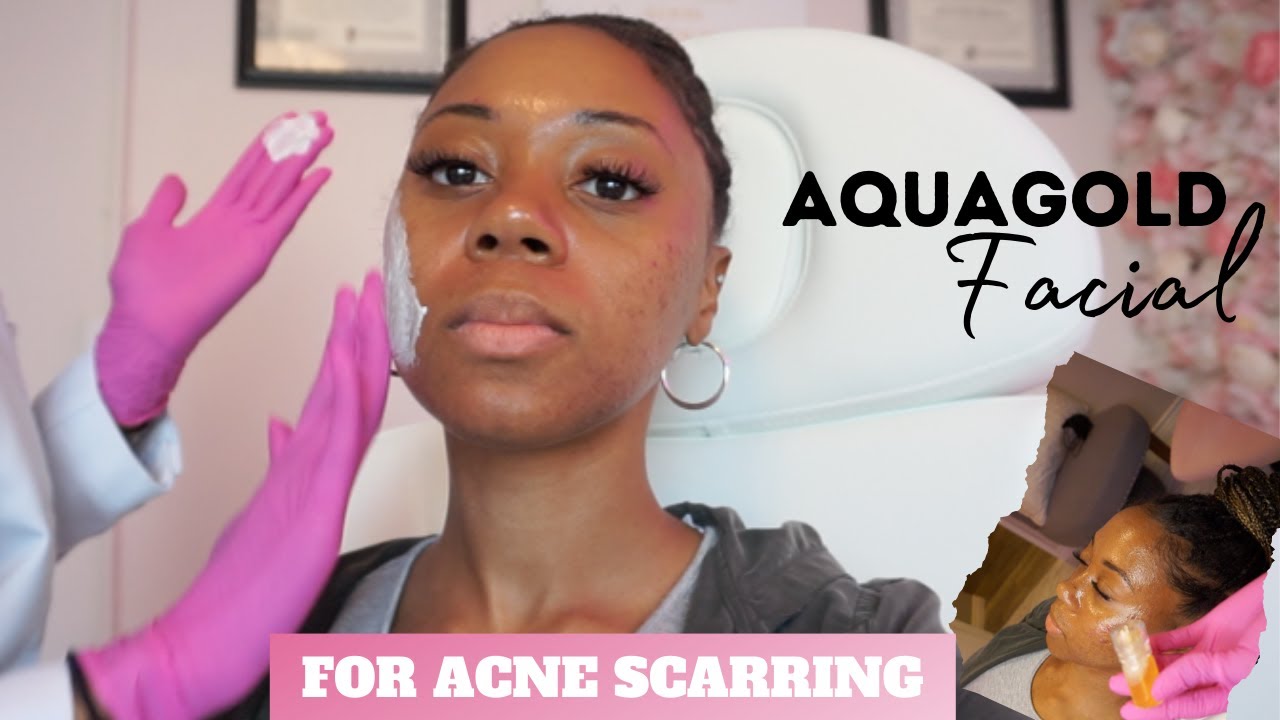 Aqua Gold Facial Before and After Vlog | At Phresh Skin - YouTube