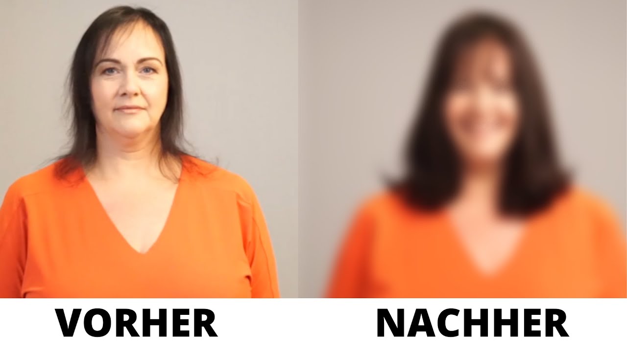 HAIRDREAMS HAIR THICKENING | BEFORE AND AFTER | MICROLINES SYSTEM ...