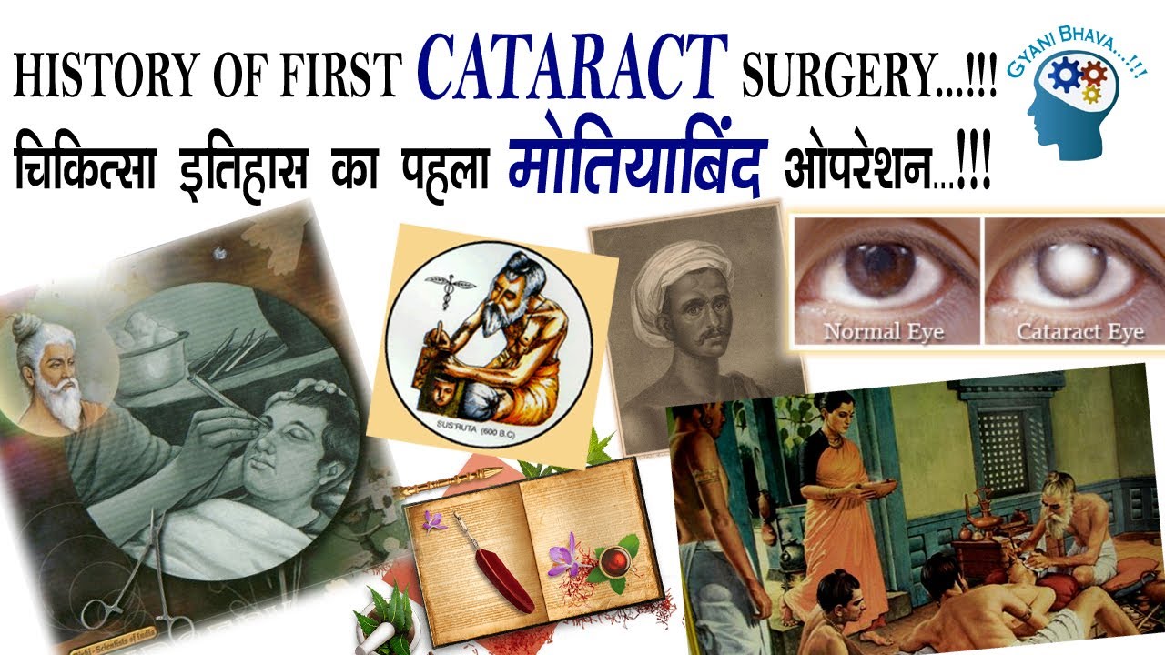 HISTORY OF VERY FIRST CATARACT SURGERY OF MEDICAL Science (Hindi ...