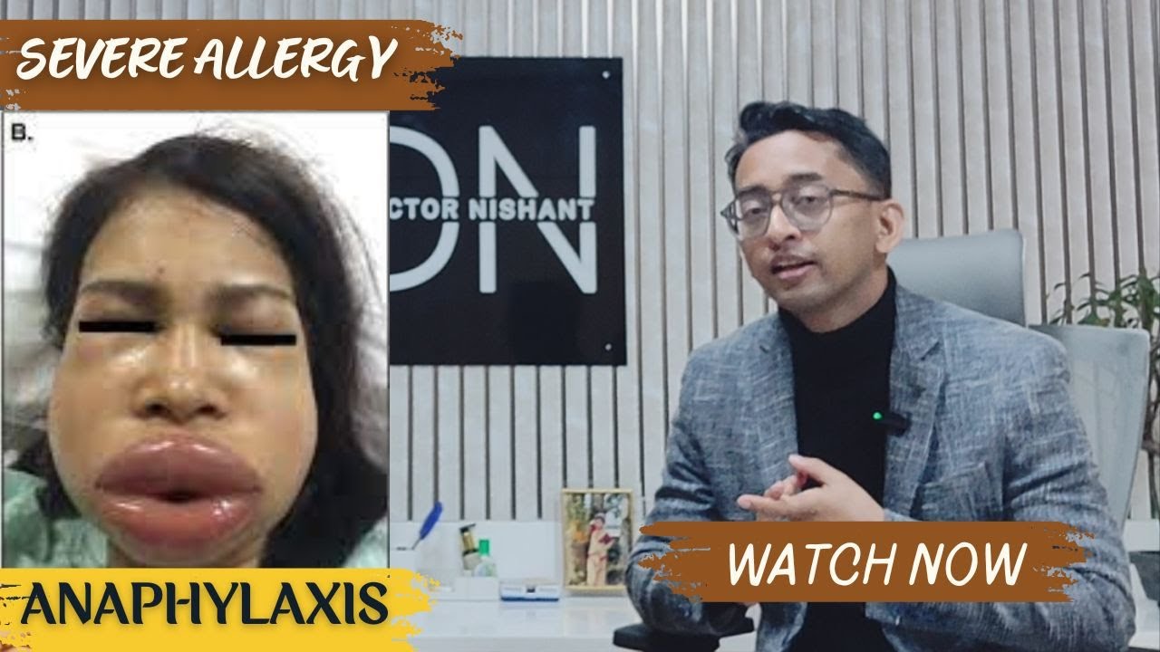 Severe Allergic Reaction | Understanding Anaphylaxis: Symptoms, Causes ...