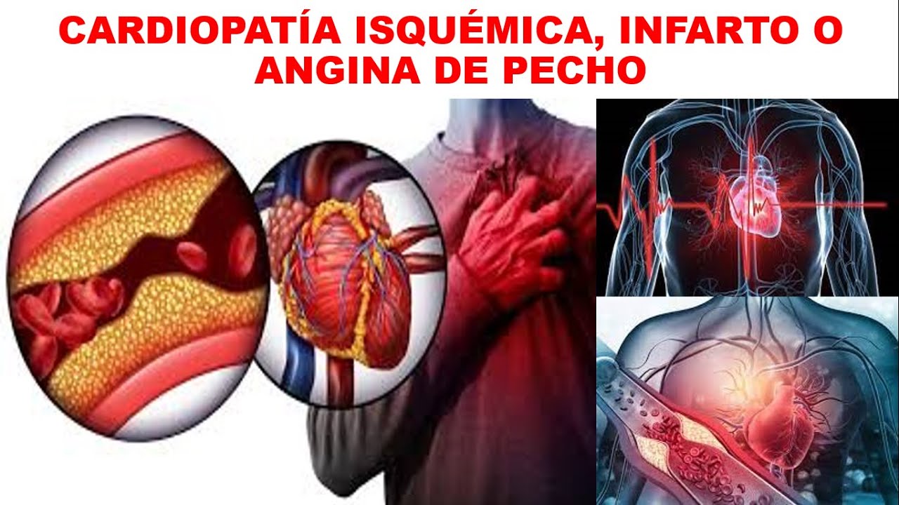 CARDIOPATÍA ISQUÉMICA, INFARTO O ANGINA DE PECHO - YouTube
