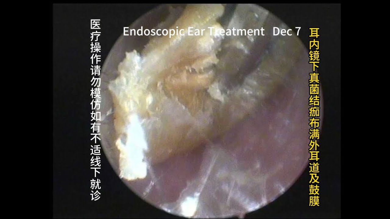 Appearance and treatment methods of fungal otitis externa 20231207 ...