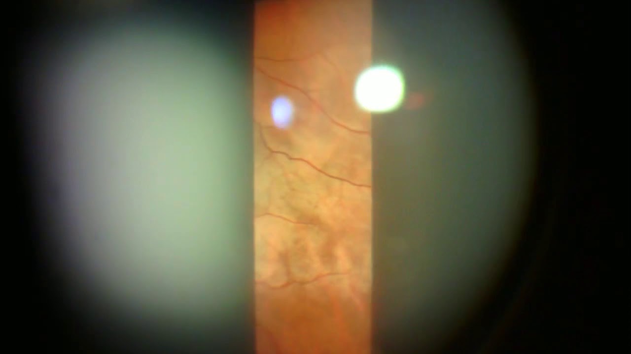 Commotio Retinae - YouTube
