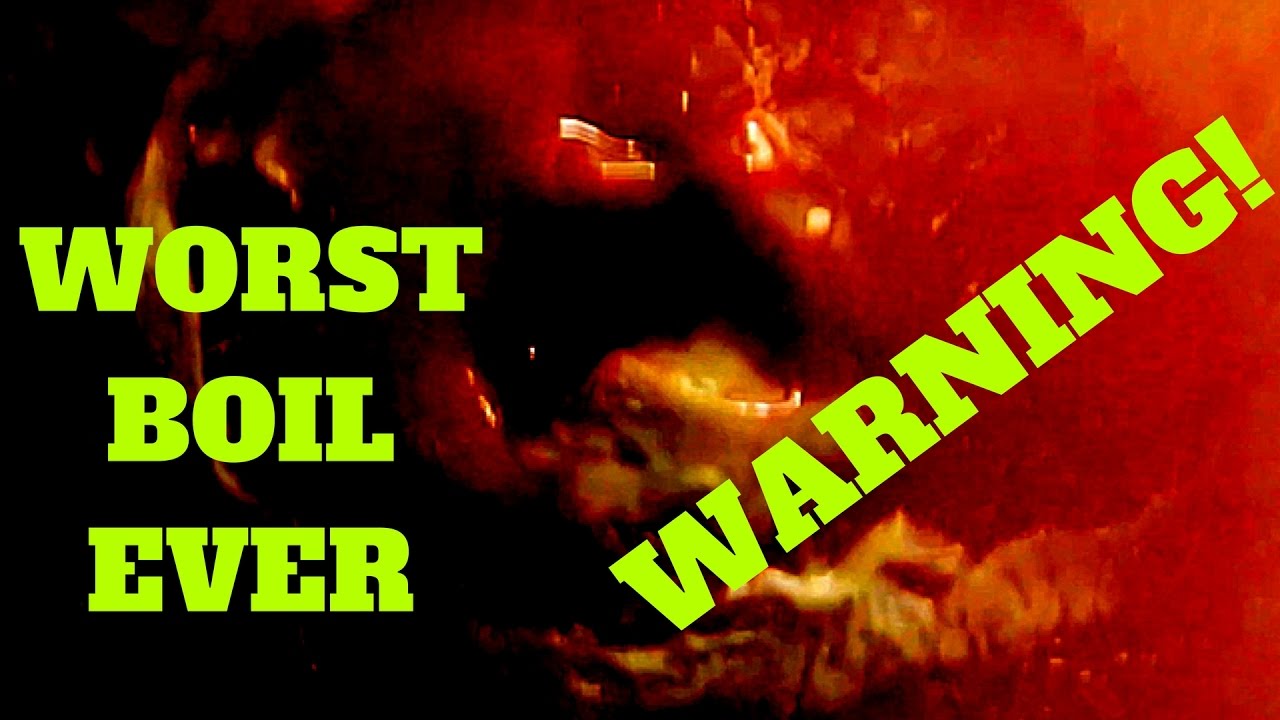 THE WORST BOIL IN THE WORLD EVER (BLOOD WARNING) - YouTube
