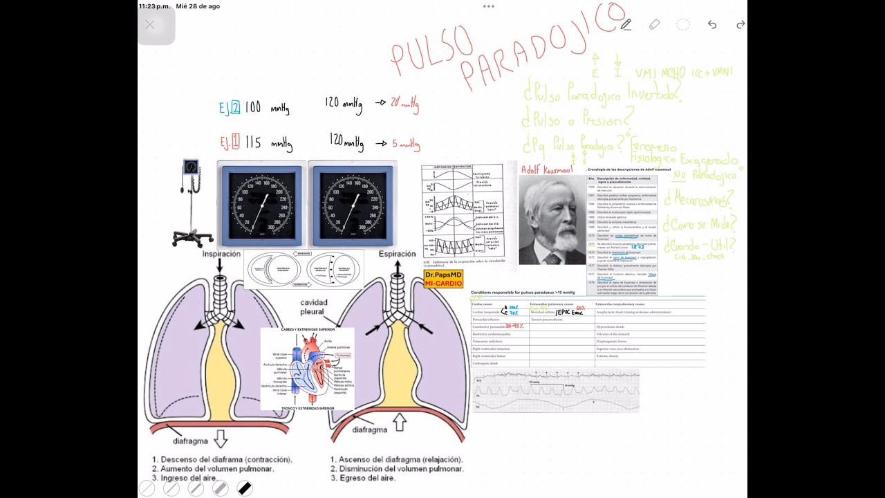 PULSO PARADOJICO (Aspectos esenciales para su comprensión) Dr.PapsMD MI ...