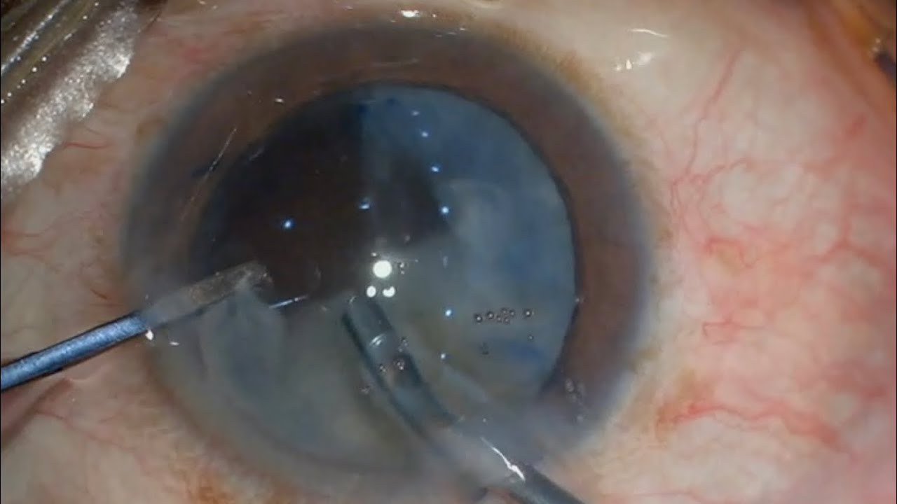 Posterior capsular tear at the start of Phaco, what to do? - YouTube