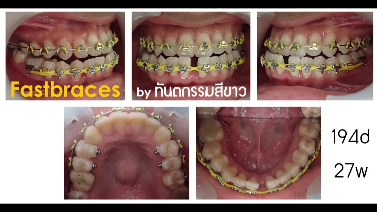 Ορθοδοντικό σύστημα Fastbraces, Ορθοδοντική, Σιδεράκια, Ίσια δόντια ...