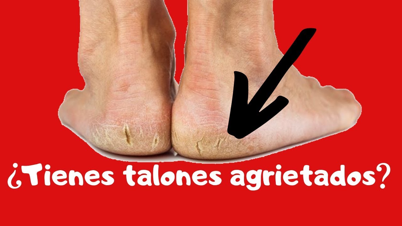 Remedios caseros para sanar los talones agrietados - YouTube