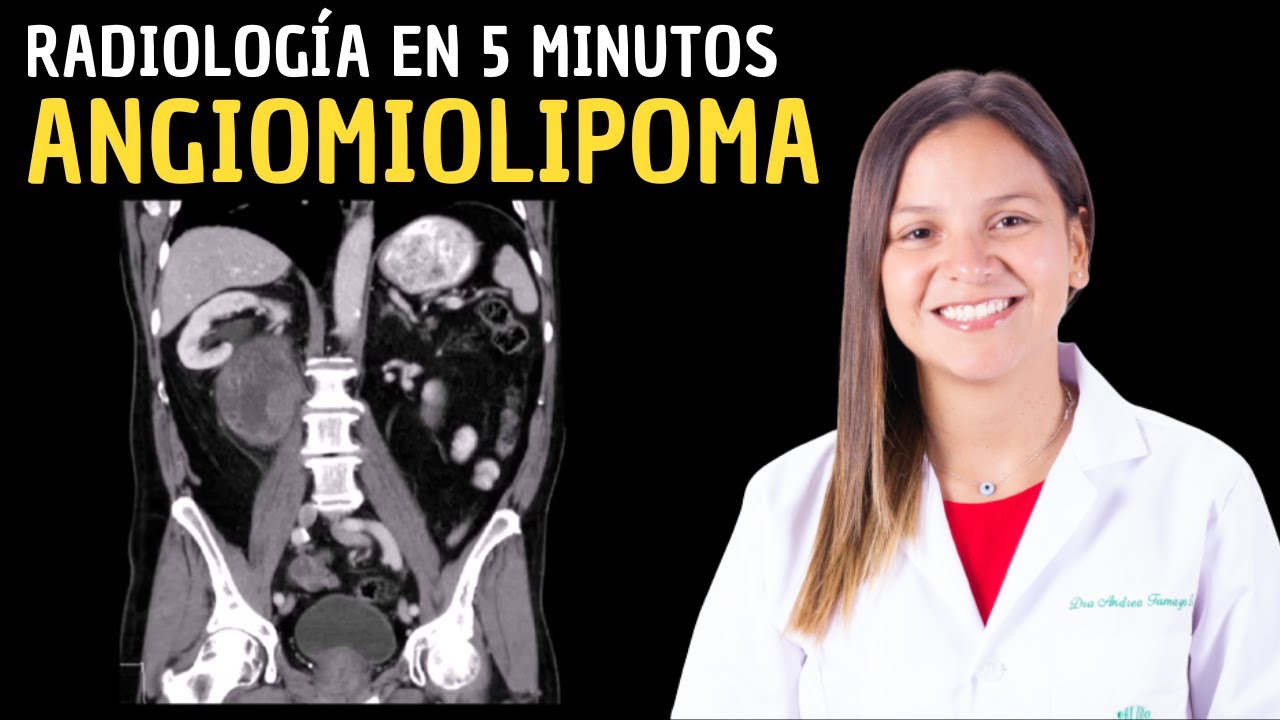 Radiología en 5 minutos: Angiomiolipoma. - YouTube