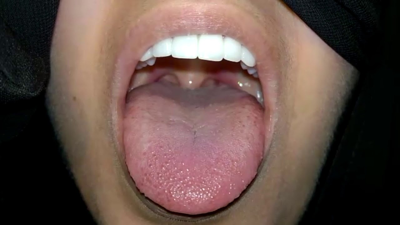 Oculopalatal Myoclonus - YouTube