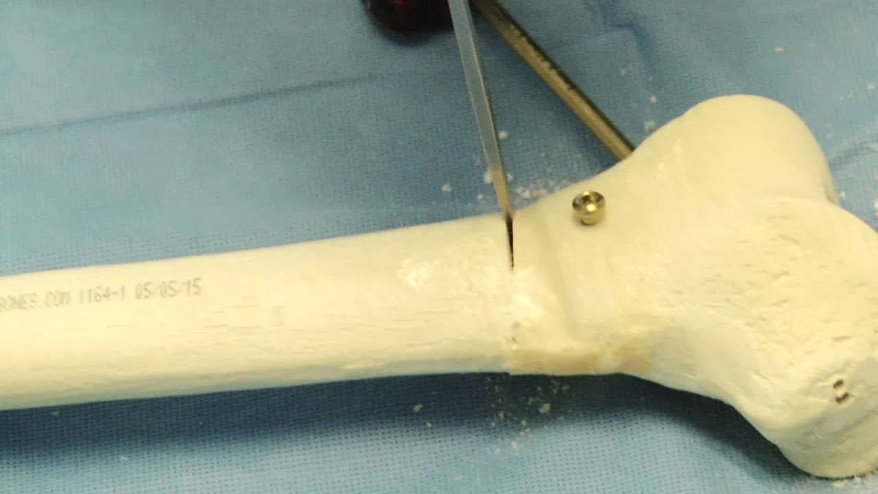 PRECICE: Retrograde Nail Technique (Dr. Fragomen - HSS, NYC) - YouTube