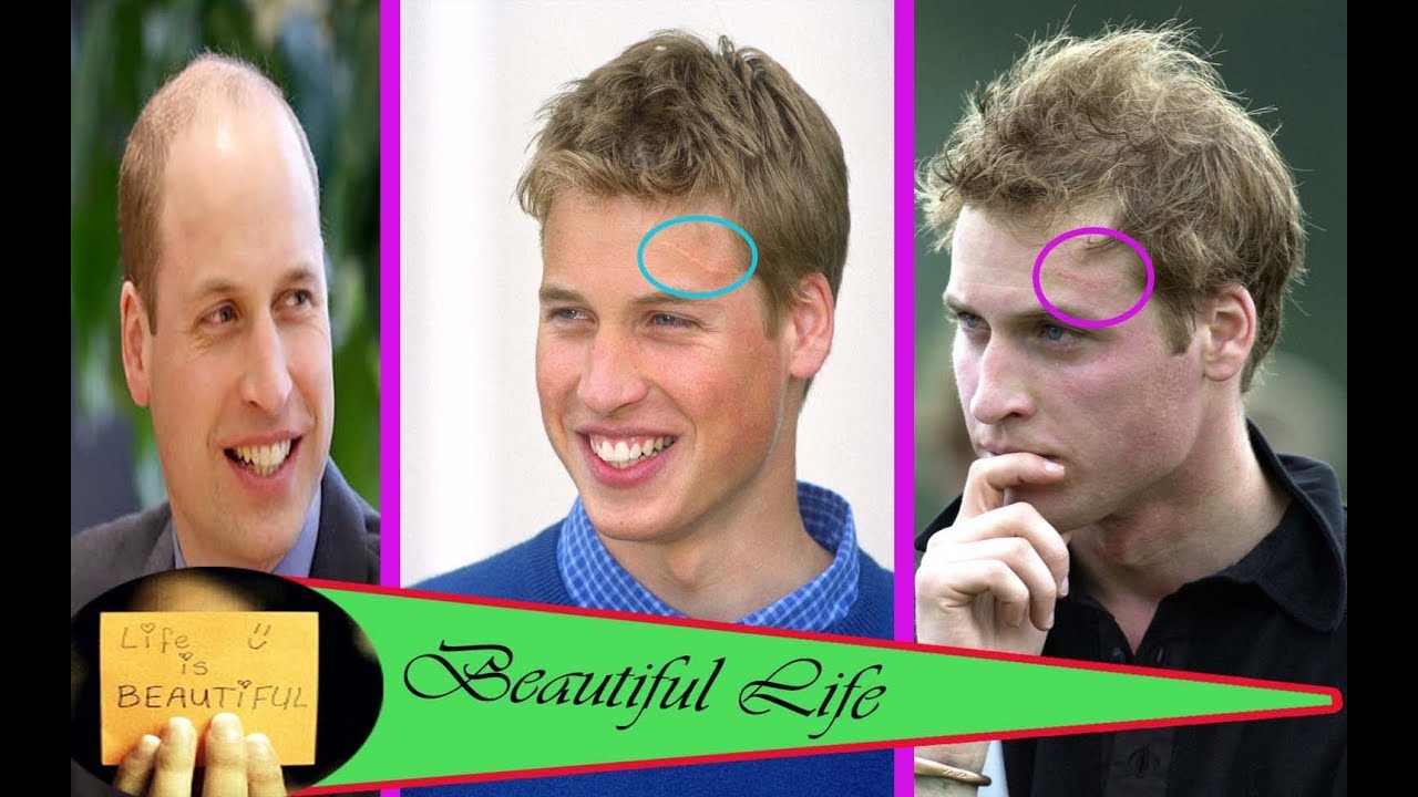 How did Prince William try to hide the scar on his forehead? - YouTube