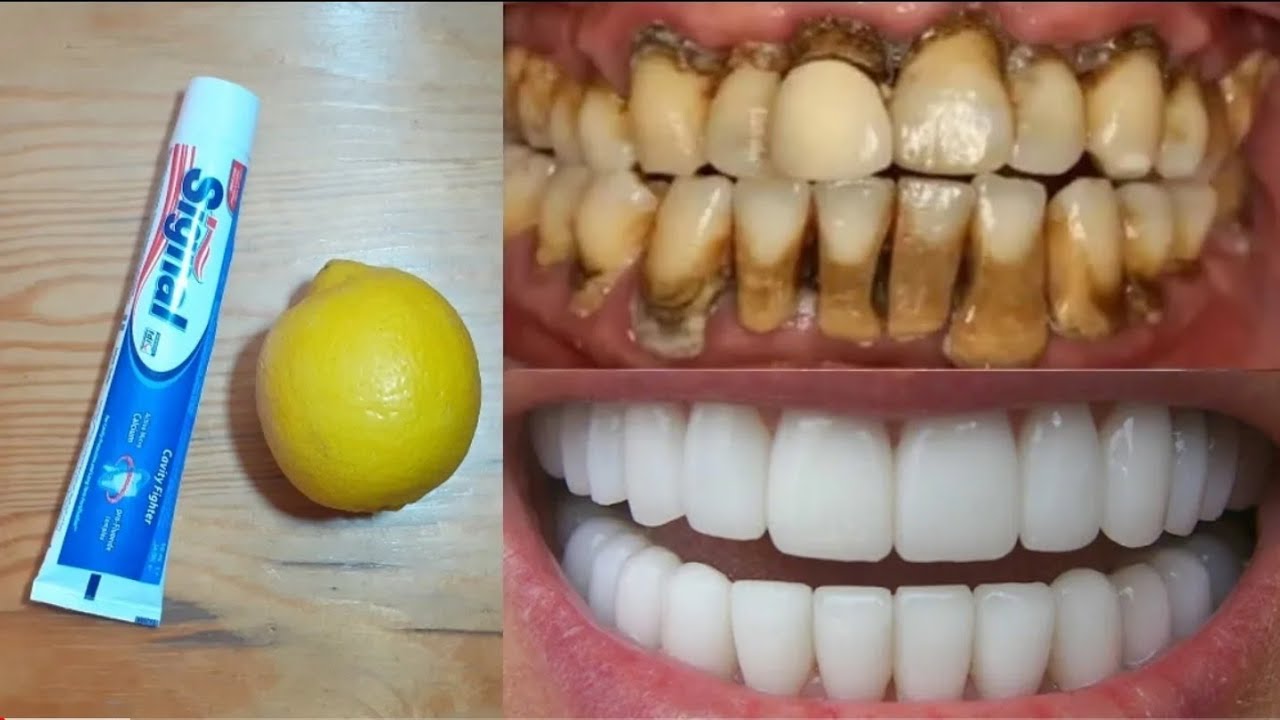 في دقيقة ، كيفية التخلص من اصفرار الأسنان خليط طبيعي لتبييض الأسنان Youtube