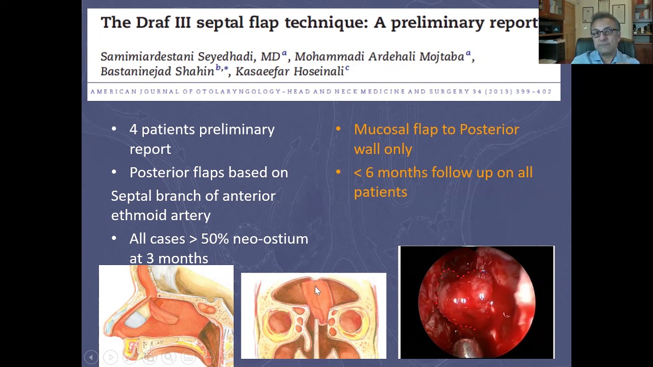 Extended Approaches to Frontal Sinus Surgery - YouTube
