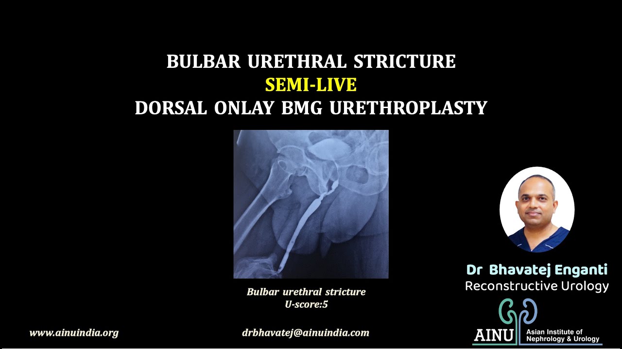 Dorsal onlay BMG urethroplasty for Bulbar Urethral stricture - YouTube