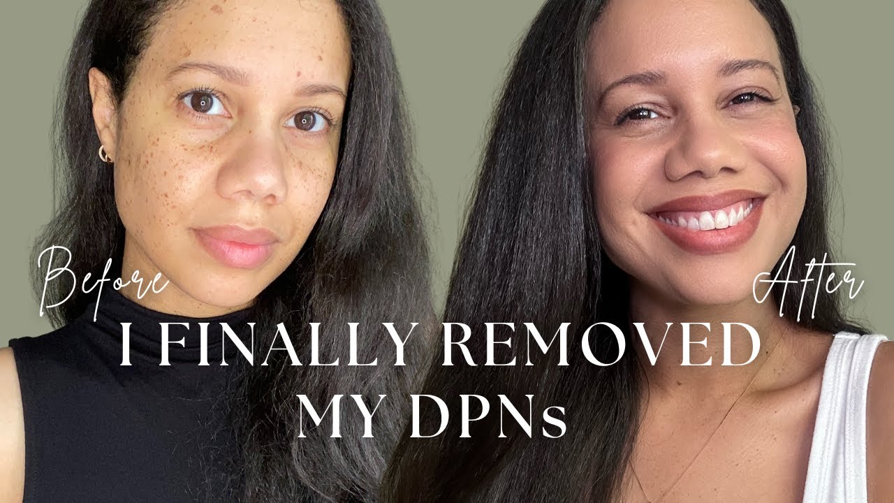 Unveiling the Secrets of DPN Removal & Skin Recovery! - YouTube