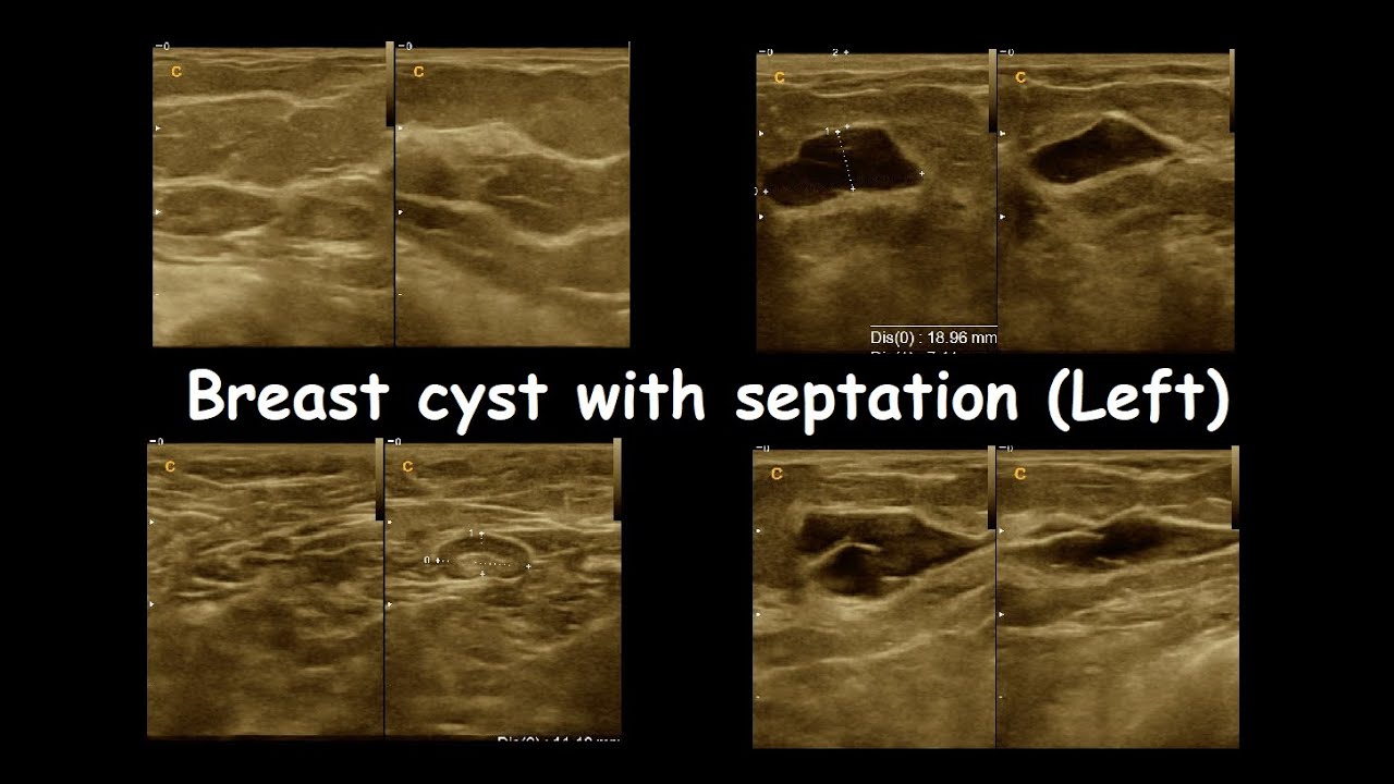 Breast Exam for Beast Cyst || Breast cyst with septation (Left ...