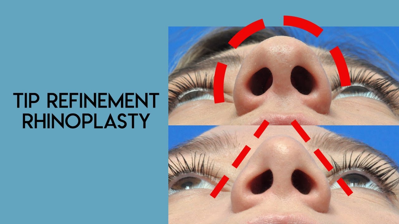 Tip Refinement Rhinoplasty - YouTube