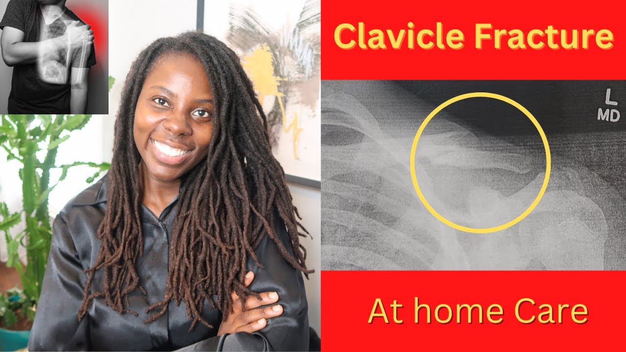 Clavicle Fracture- At home care, Pain relief, & Recovery | Do Clavicle ...