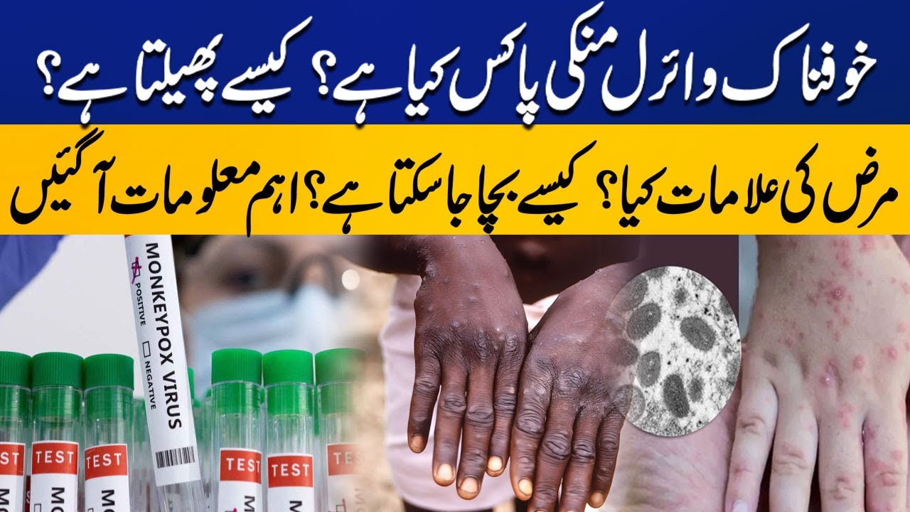 What Is Monkey Pox ?? How It Spread ?? Symptoms Of Virus ?? | How To ...