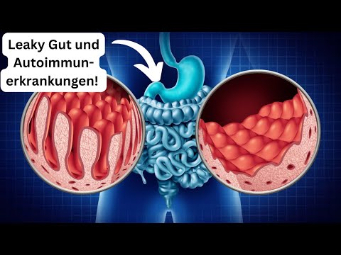 Biofilm im Darm entfernen! Wirkungsvollste Darmreinigung der Welt!