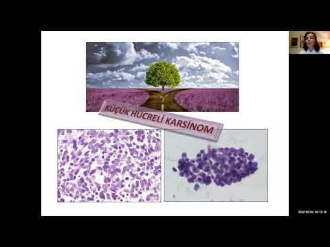 TPD - Akciğer Kanserinde Küçük Biyopsi ve Sitoloji Materyallerine Yaklaşım ve Tuzak Olgular