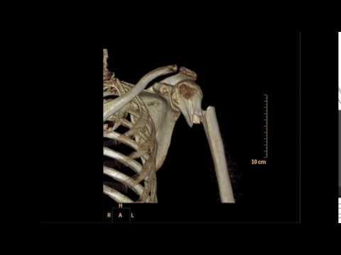 Proximal Humeral fracture 2 part - 01 CT Scan - YouTube